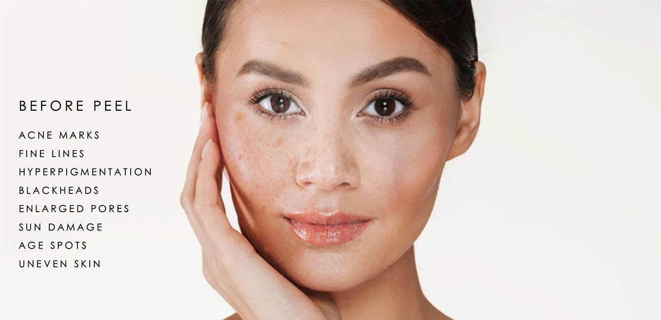 Home Skin Peels and Skin Care Treatments | Skin Culture